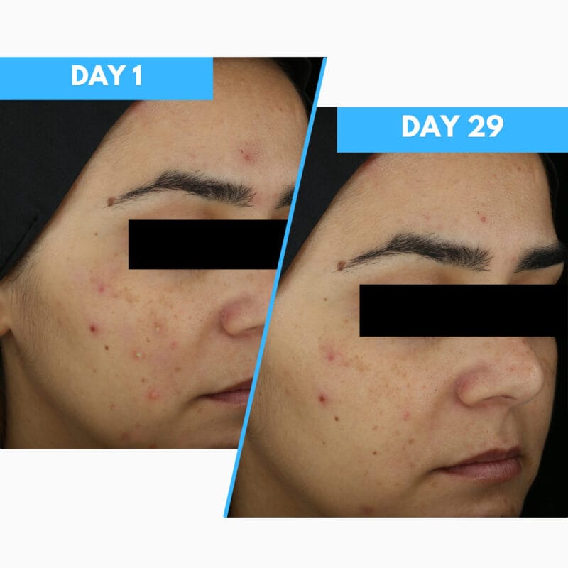 Anti-Acne Cream - Acne Clear - for problematic Skin 50 ml - Synergy ...